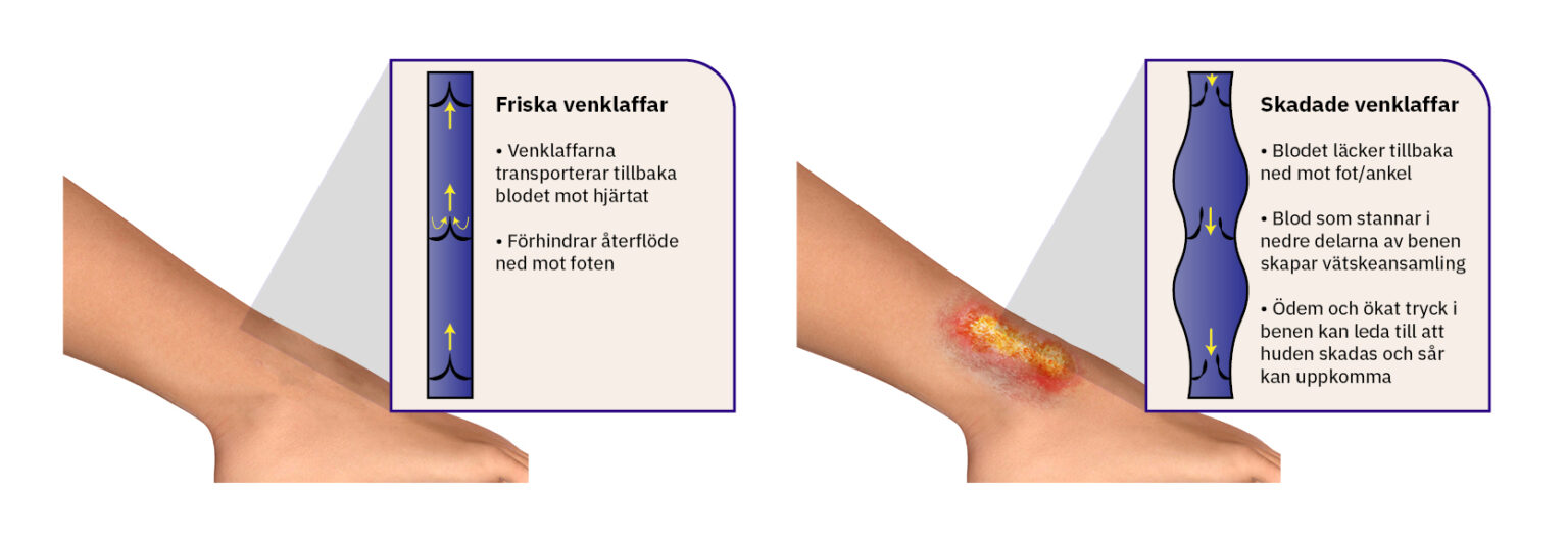 Så här lägger du om venösa vätskande bensår | Guidning och tips